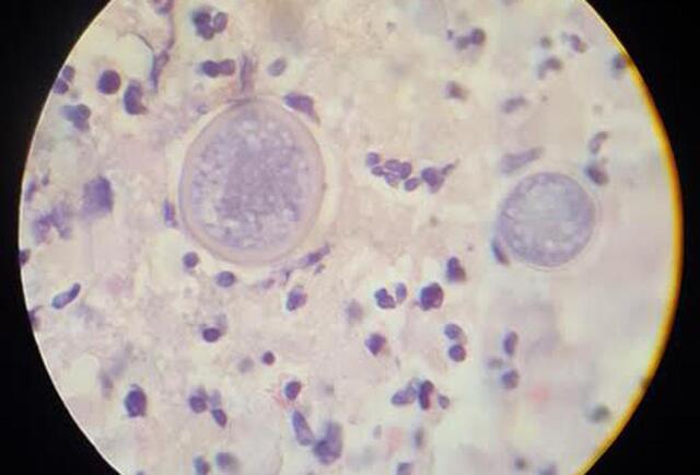Valley fever | SLO County cases on the rise, 5 deaths already | San ...